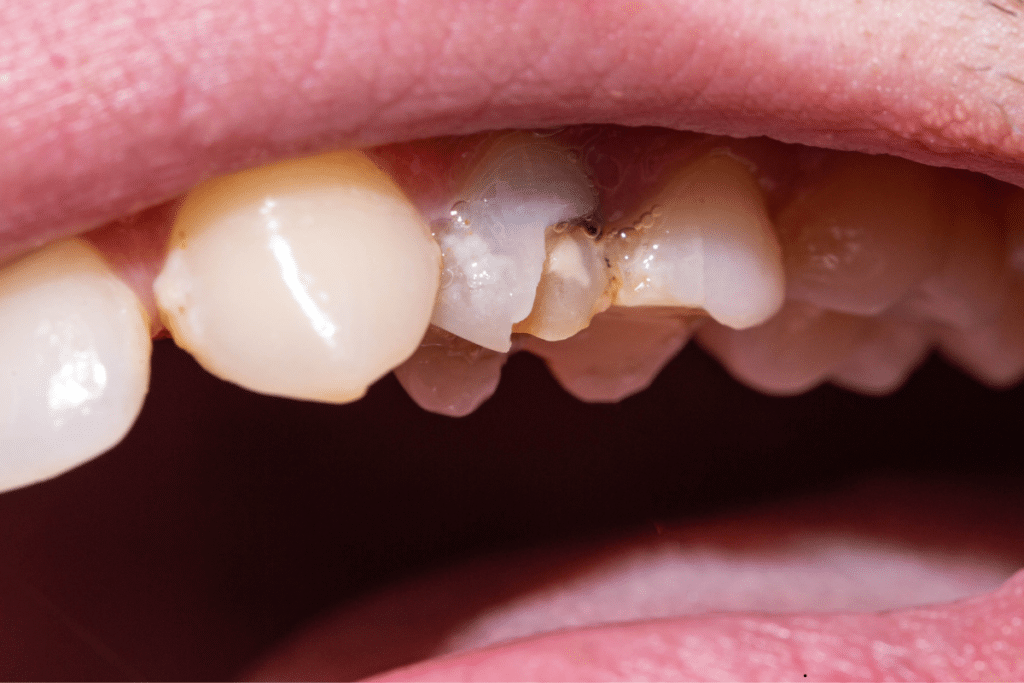 How Cosmetic Dentists Fix Chipped or Uneven Teeth